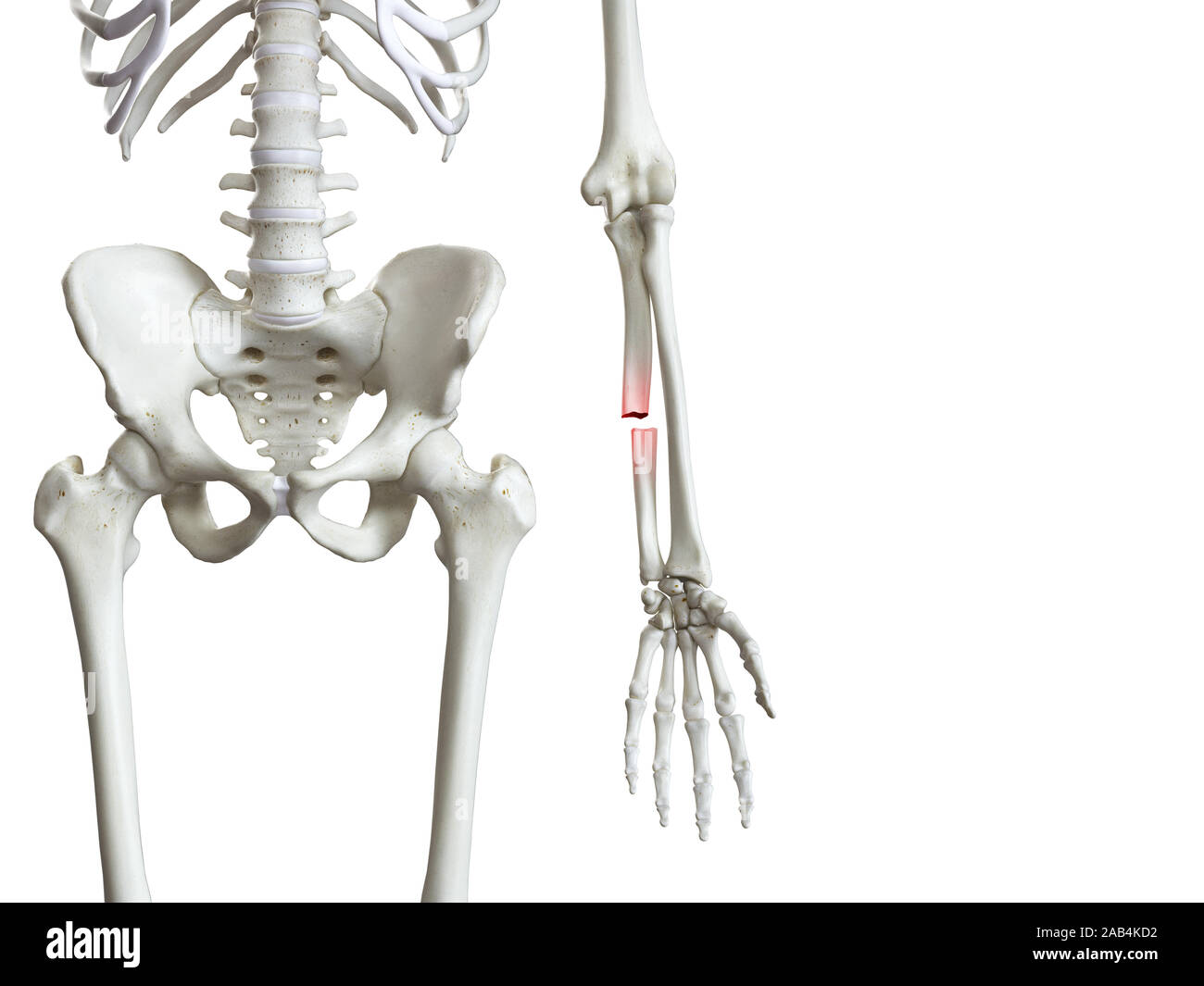 Ulna fracture hi-res stock photography and images - Alamy