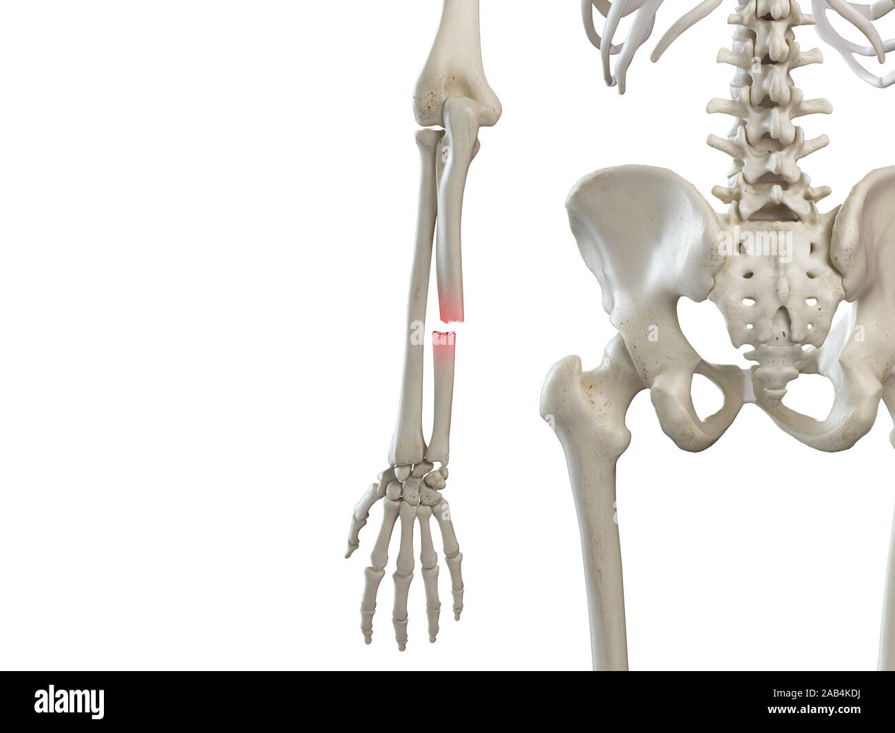 3d rendered medically accurate illustration of a broken ulna Stock ...