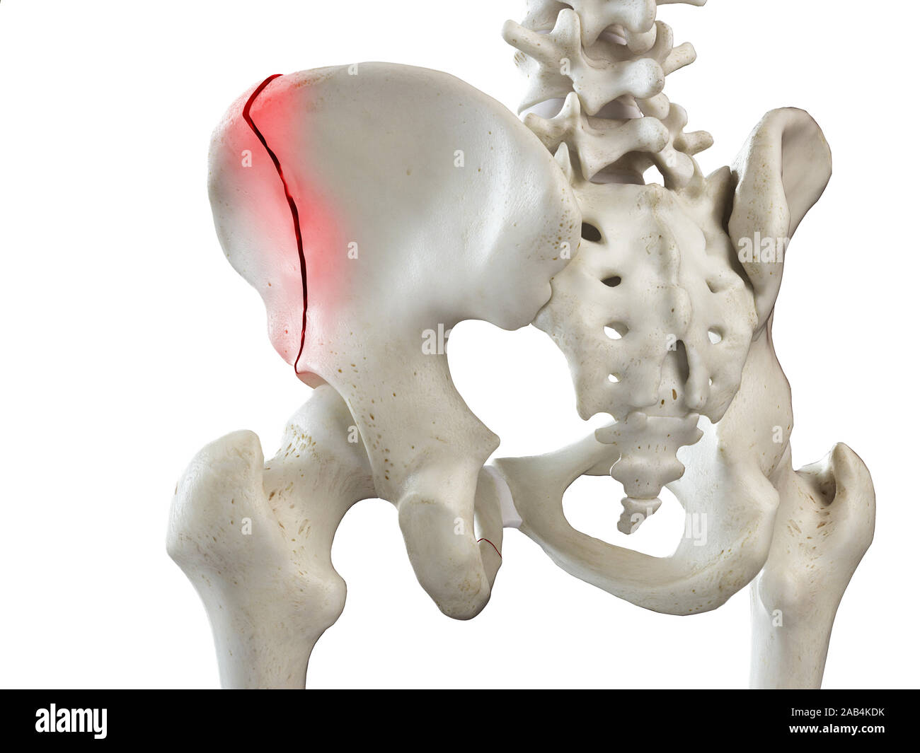Broken pelvis hi-res stock photography and images - Alamy