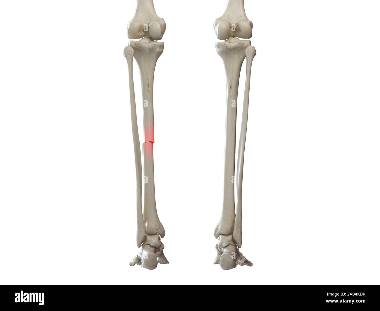 3d rendered medically accurate illustration of a broken tibia Stock ...