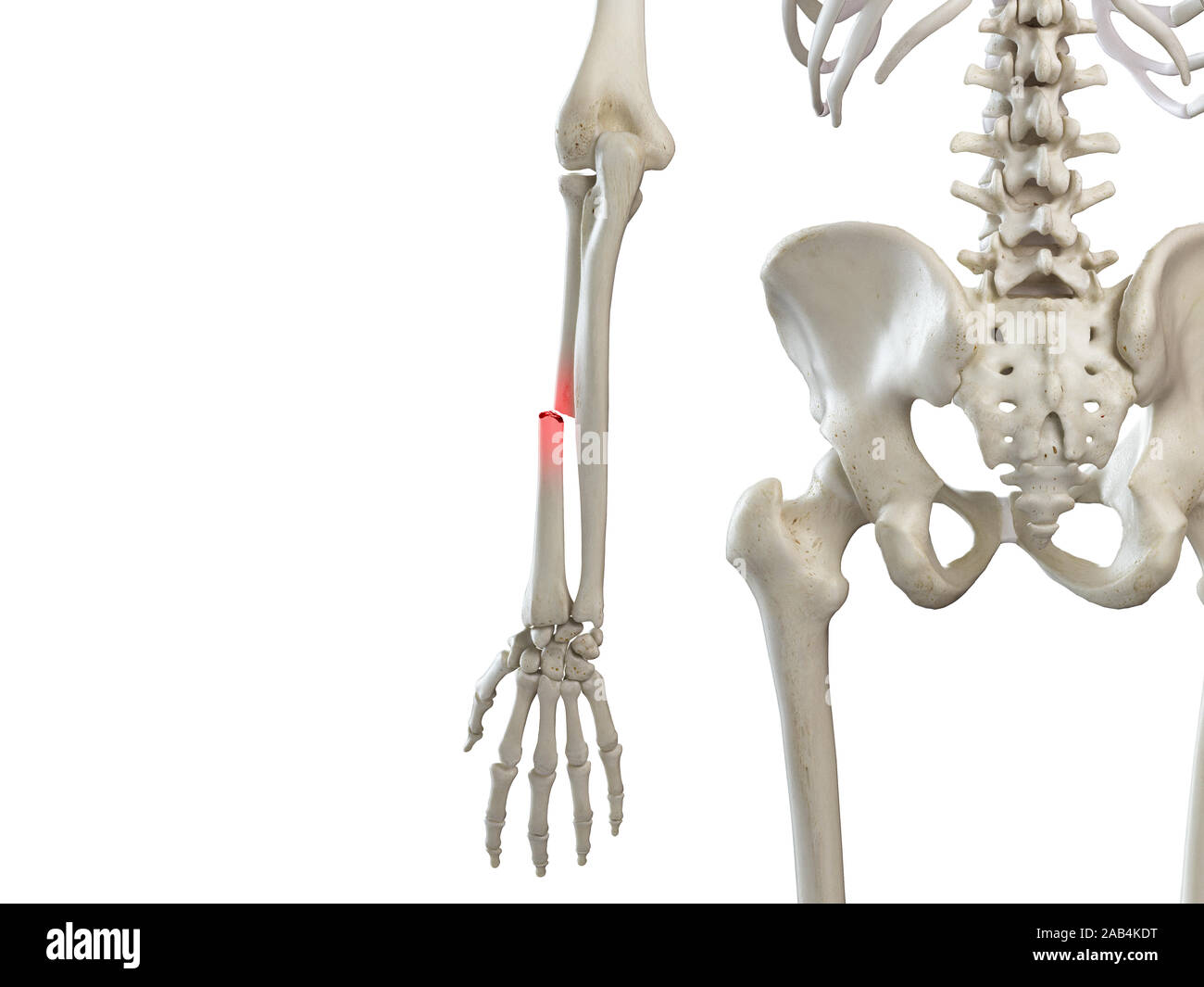 Broken radius hi-res stock photography and images - Alamy