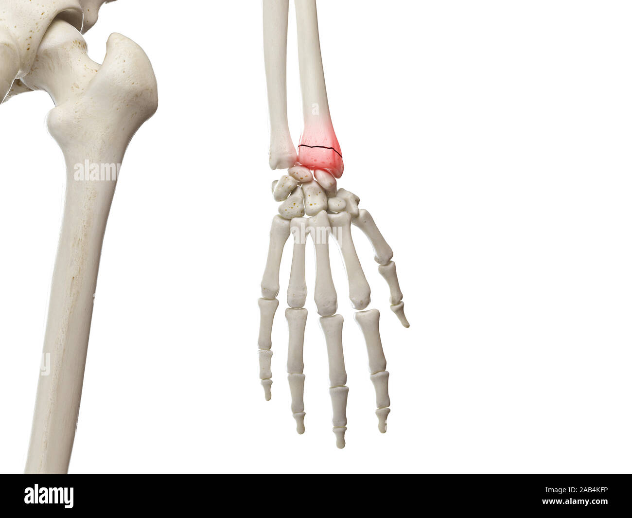 Broken Wrist High Resolution Stock Photography and Images - Alamy