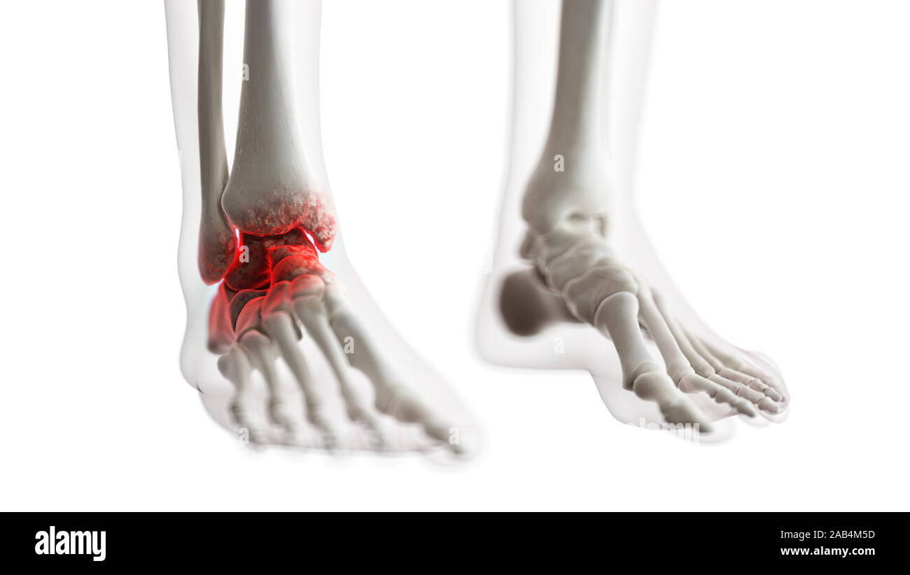 3d rendered medically accurate illustration of an arthritic ankle joint ...