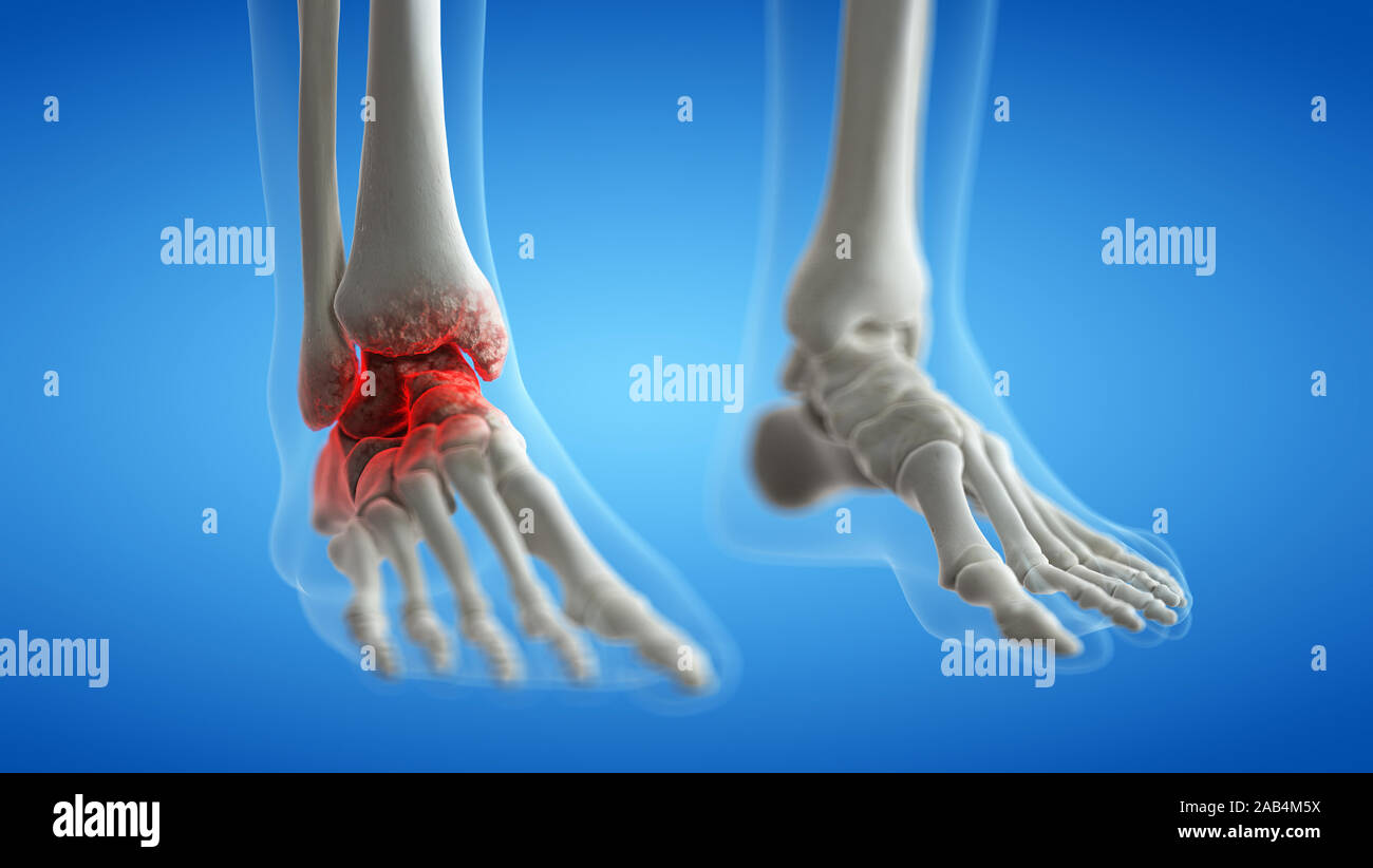 3d rendered medically accurate illustration of an arthritic ankle joint ...