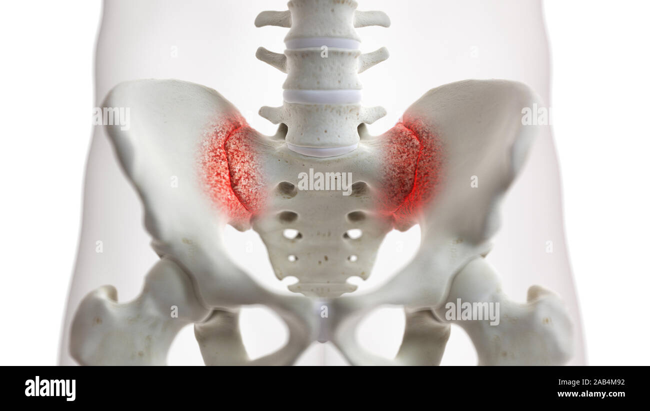 Sacroiliac Pain High Resolution Stock Photography and Images - Alamy