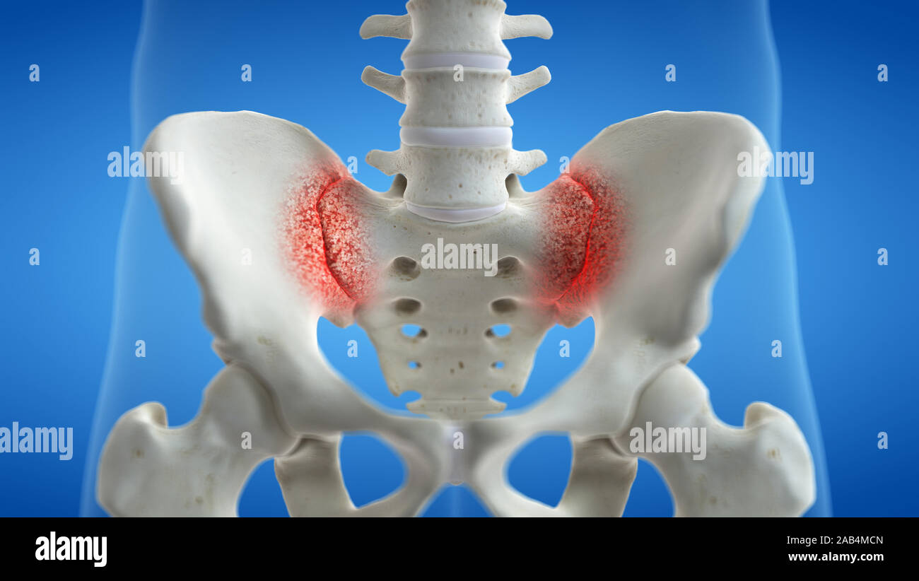 3d rendered medically accurate illustration of an arthritic iliosacral ...