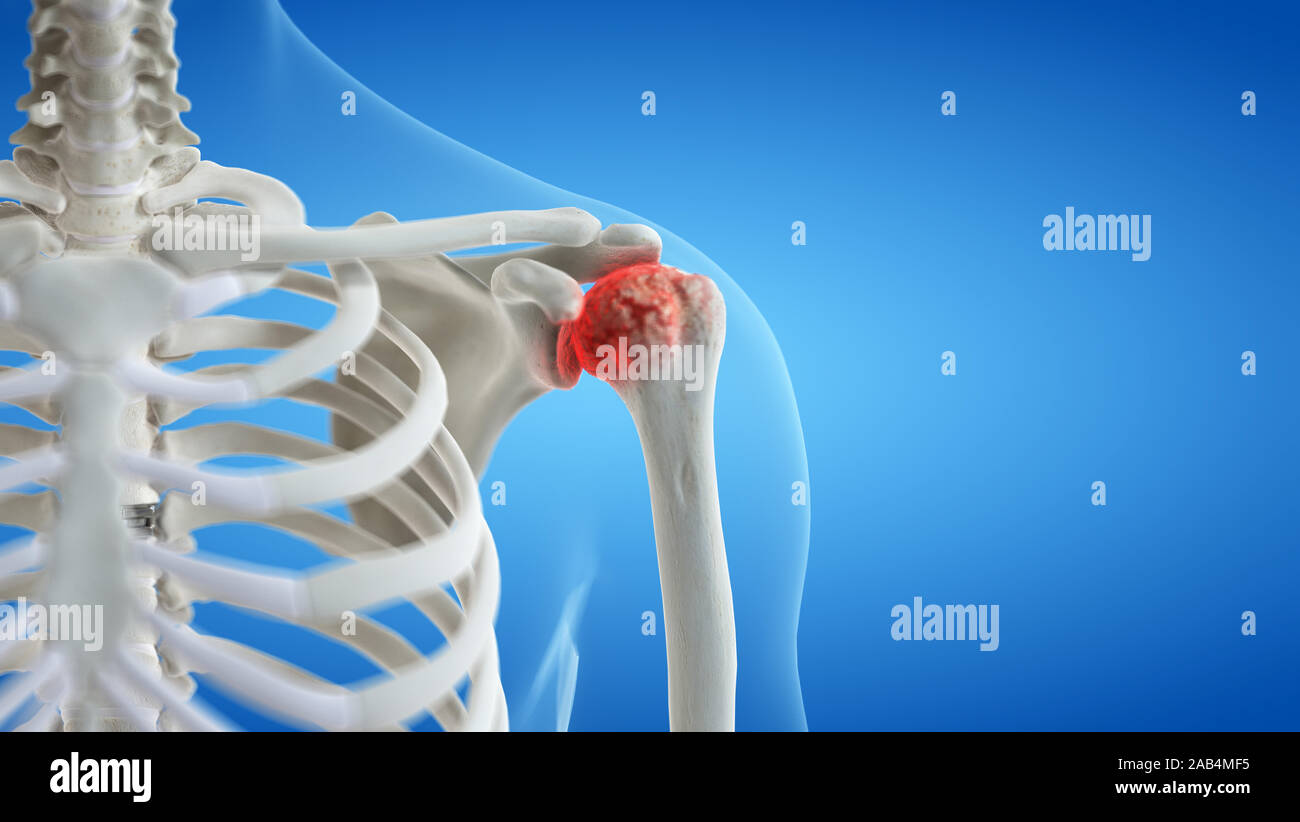 3d rendered medically accurate illustration of an arthritic shoulder ...