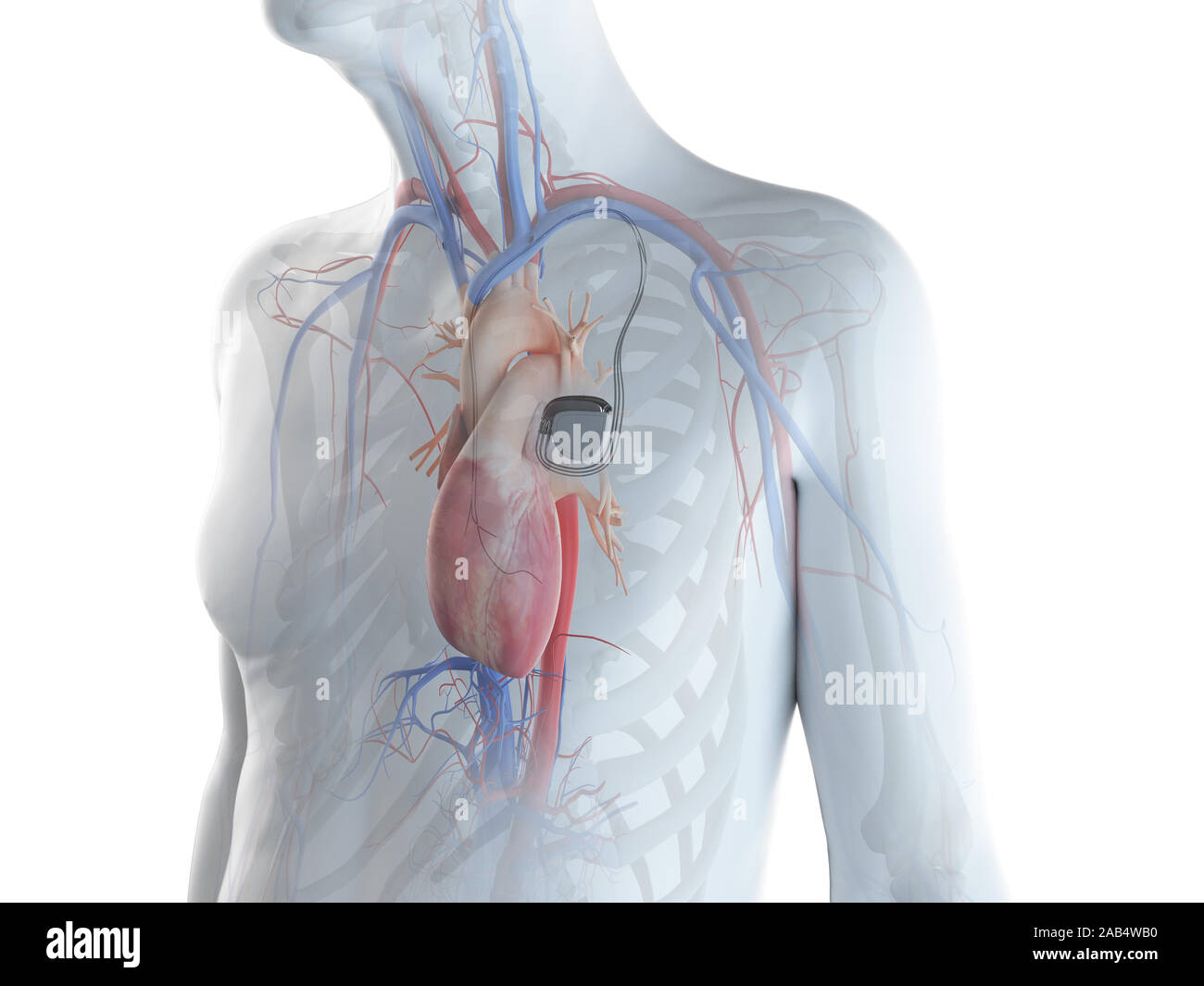Chest pacemaker hi-res stock photography and images - Alamy