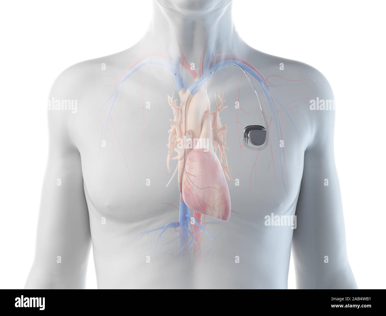 Chest pacemaker hi-res stock photography and images - Alamy