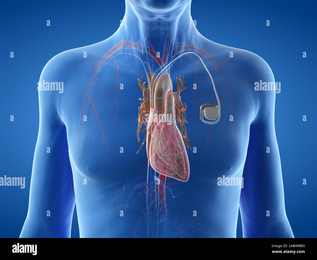 Implant pacemaker hi-res stock photography and images - Alamy