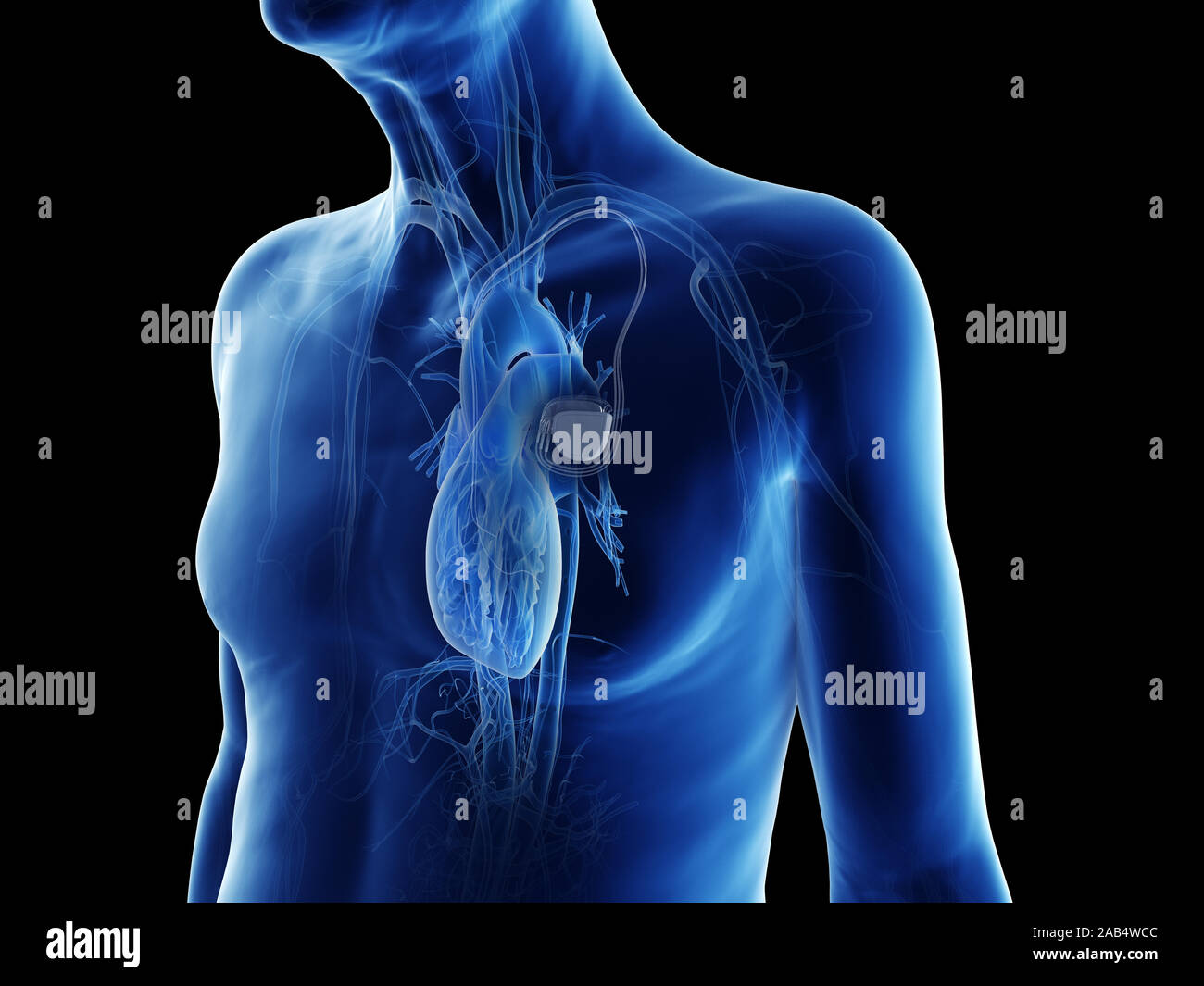 3d rendered illustration of an old man with a pace maker Stock Photo ...