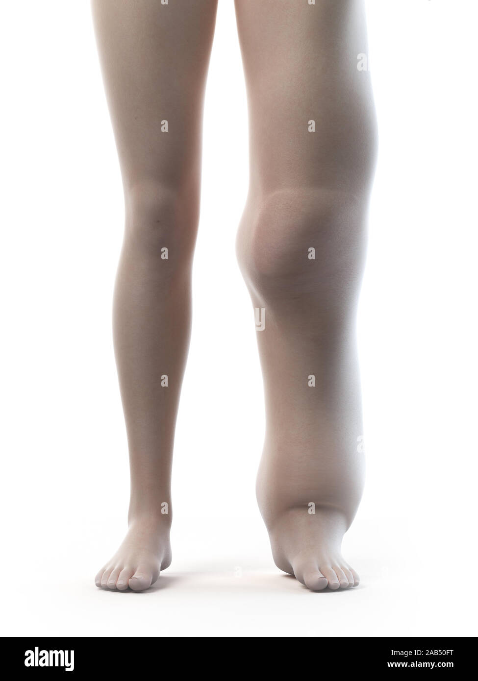 3d rendered medically accurate illustration of a lymphedema Stock Photo ...