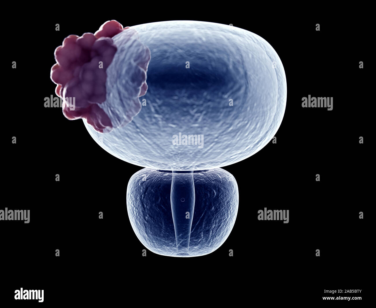3d rendered medically accurate illustration of a bladder tumor Stock ...