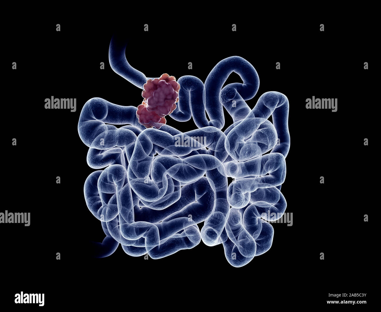 3d rendered medically accurate illustration of a small intestine tumor ...