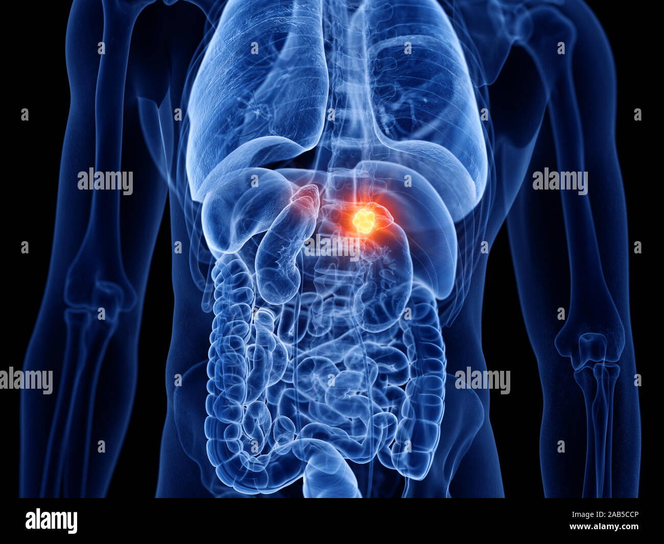 3d rendered medically accurate illustration of adrenal gland cancer ...