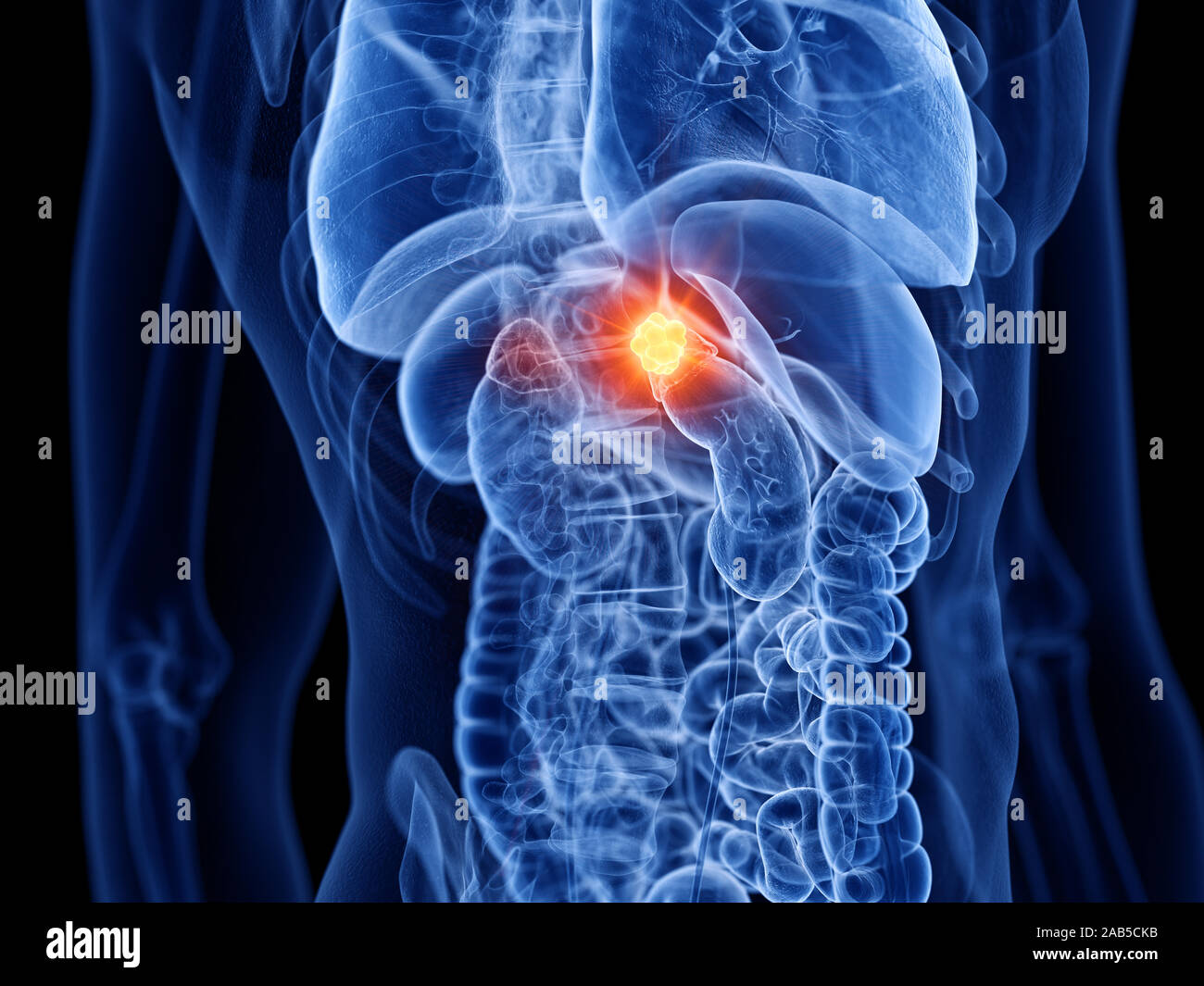 3d rendered medically accurate illustration of adrenal gland cancer ...