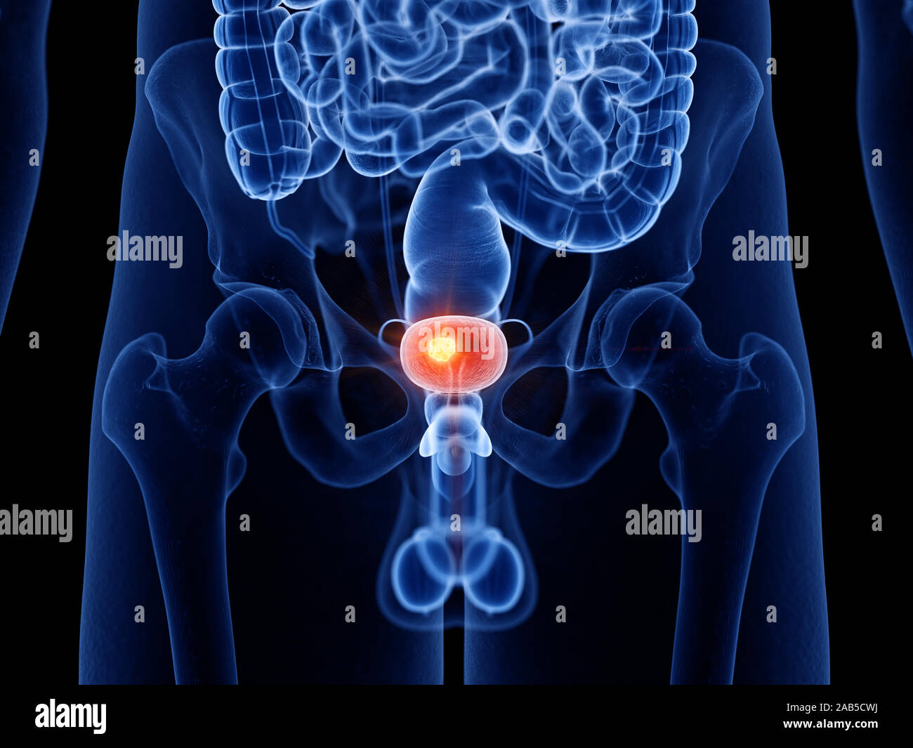 3d rendered medically accurate illustration of bladder cancer Stock ...