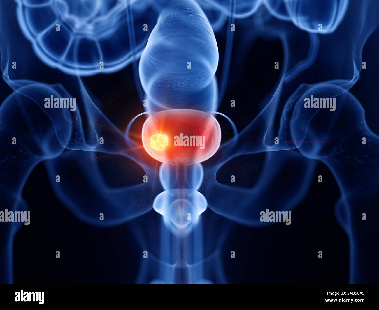 3d rendered medically accurate illustration of bladder cancer Stock ...