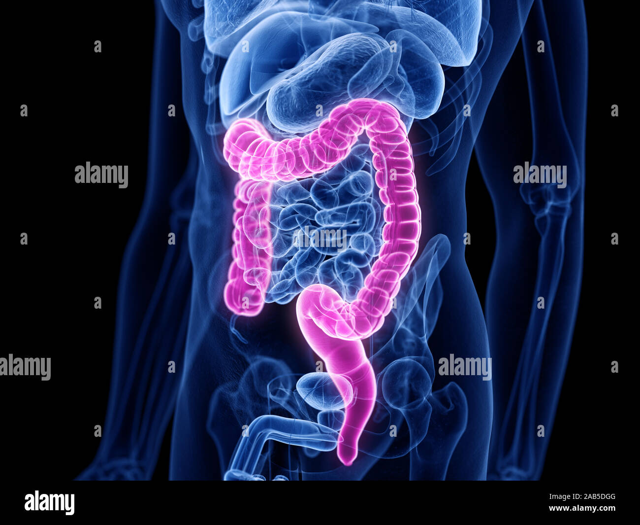 Large intestine diverticulitis hi-res stock photography and images - Alamy