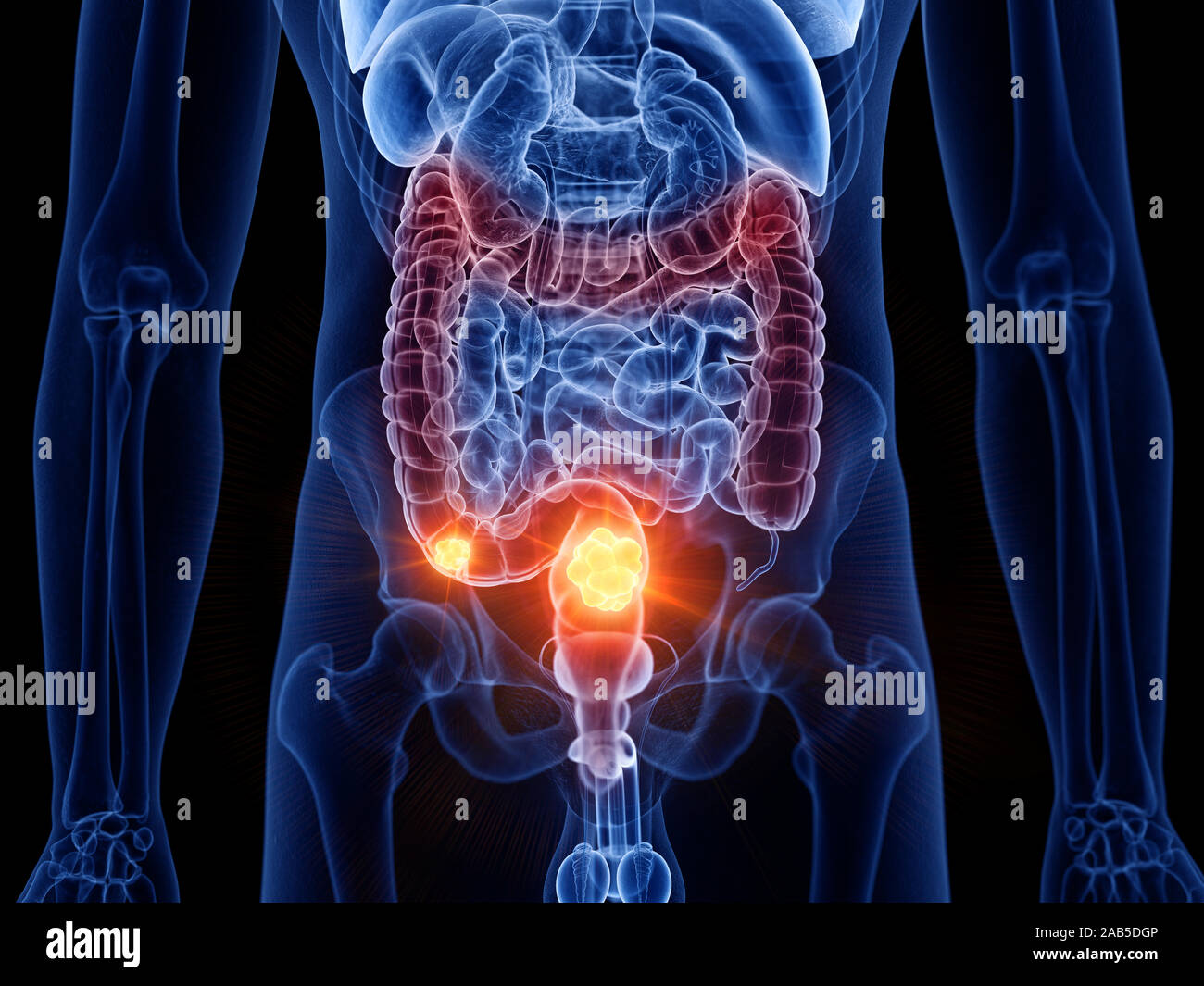 Descending colon cancer hi-res stock photography and images - Alamy