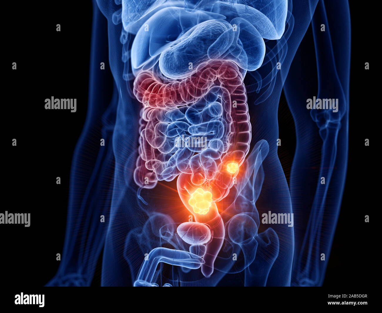 3d rendered medically accurate illustration of colon cancer Stock Photo ...