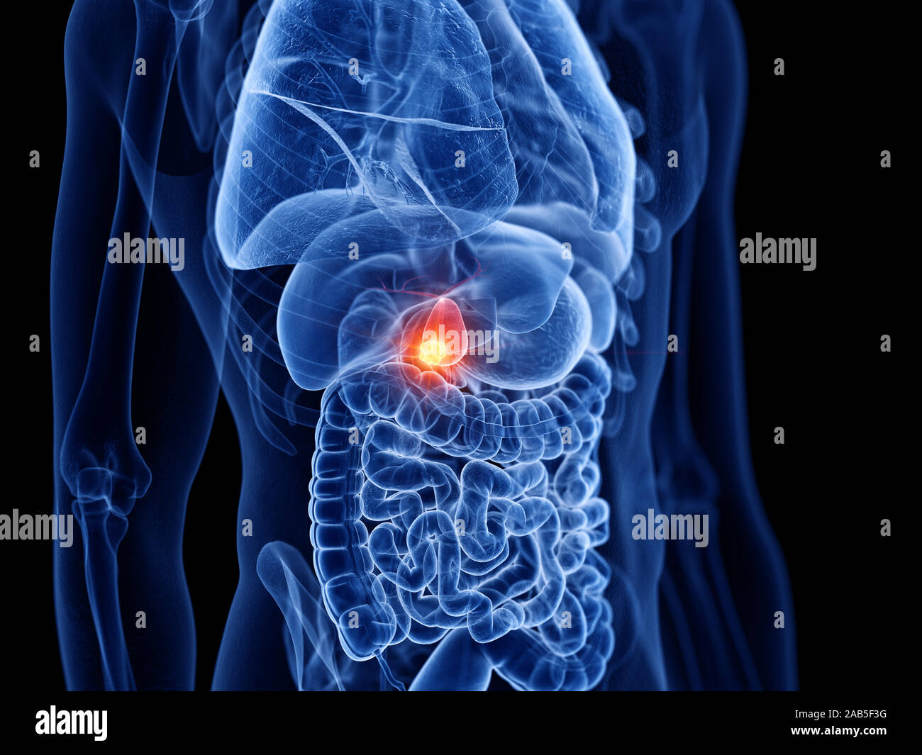 3d rendered medically accurate illustration of the gallbladder cancer ...