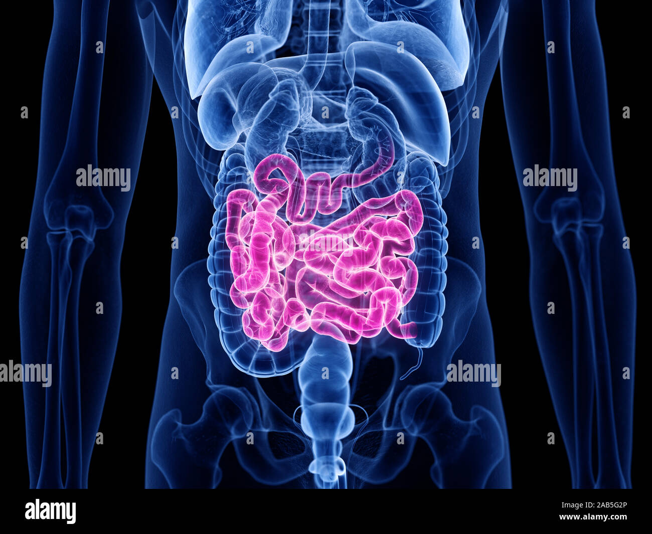 Small Bowel Obstruction High Resolution Stock Photography and Images ...