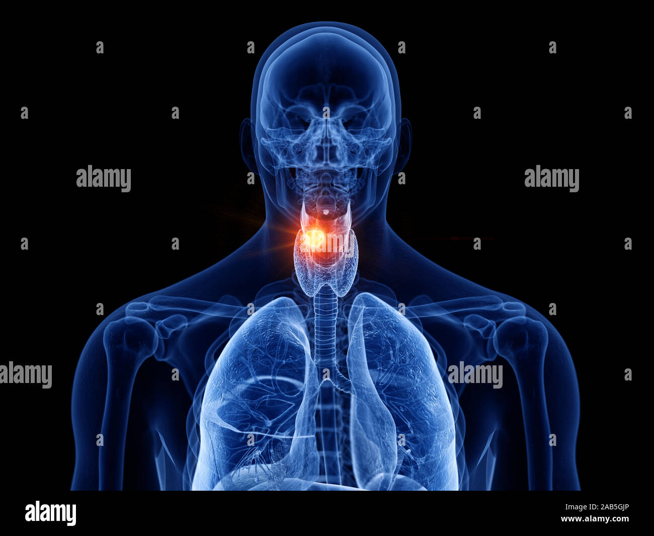 Larynx cancer artwork hi-res stock photography and images - Alamy