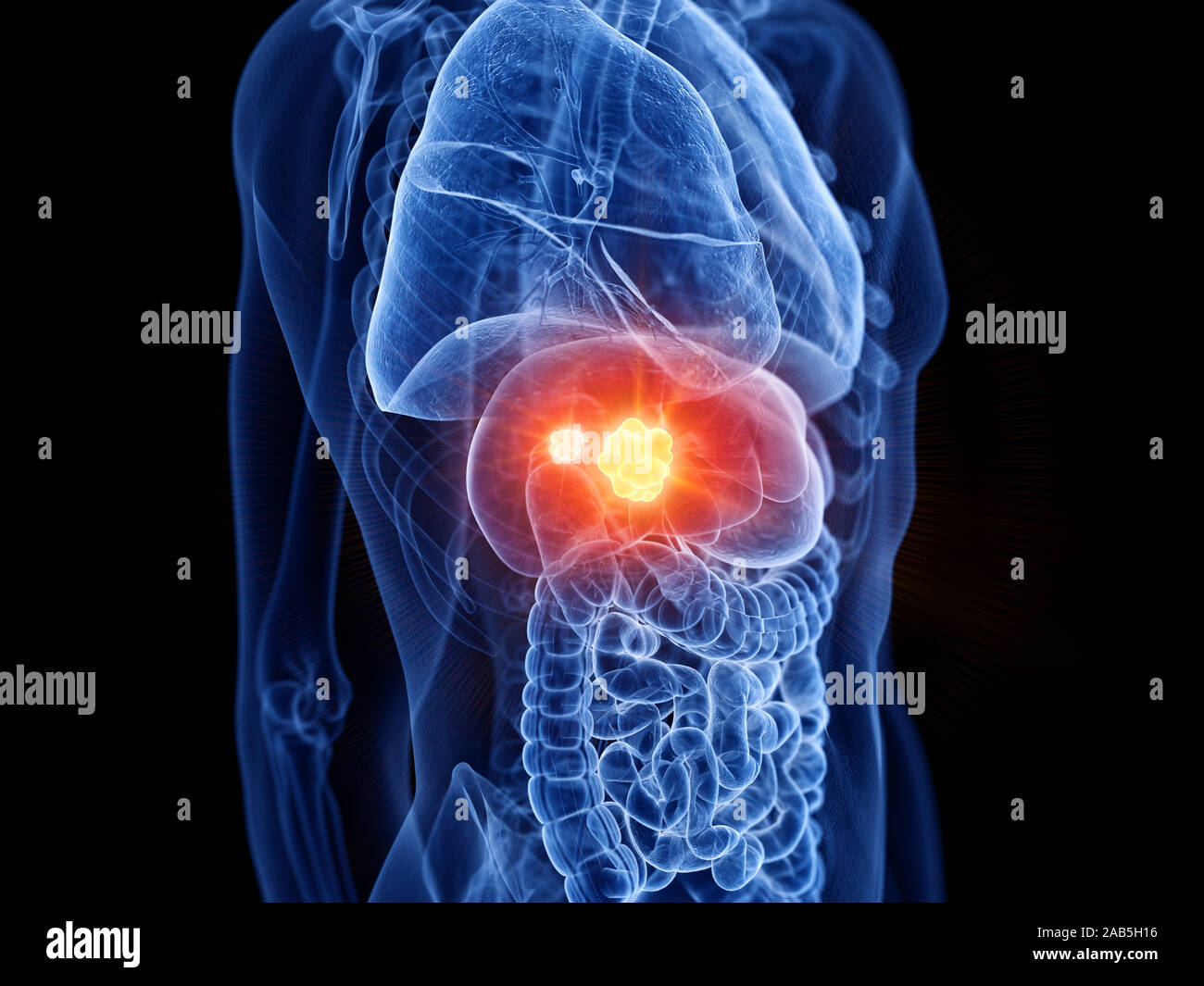 3d rendered medically accurate illustration of liver cancer Stock Photo ...