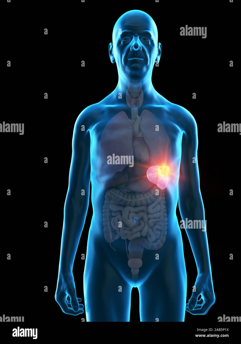 3d rendered medically accurate illustration of an old mans spleen tumor ...