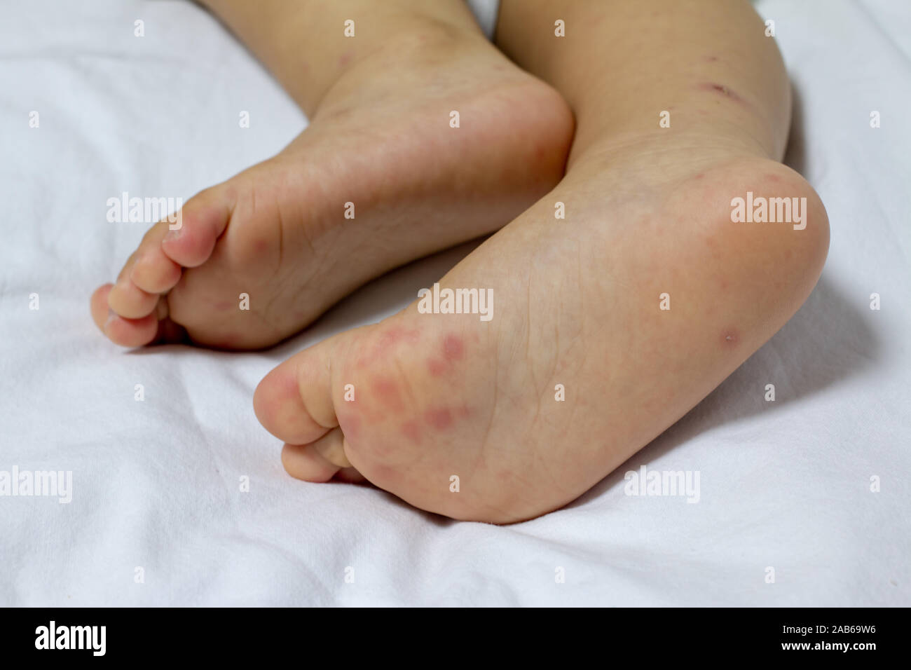 Allergic rash skin of baby's right foot. (Hand Foot and Mouth disease ...