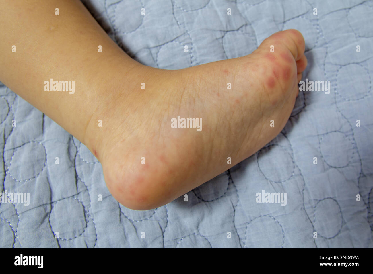 Allergic rash skin of baby's right foot. (Hand Foot and Mouth disease ...