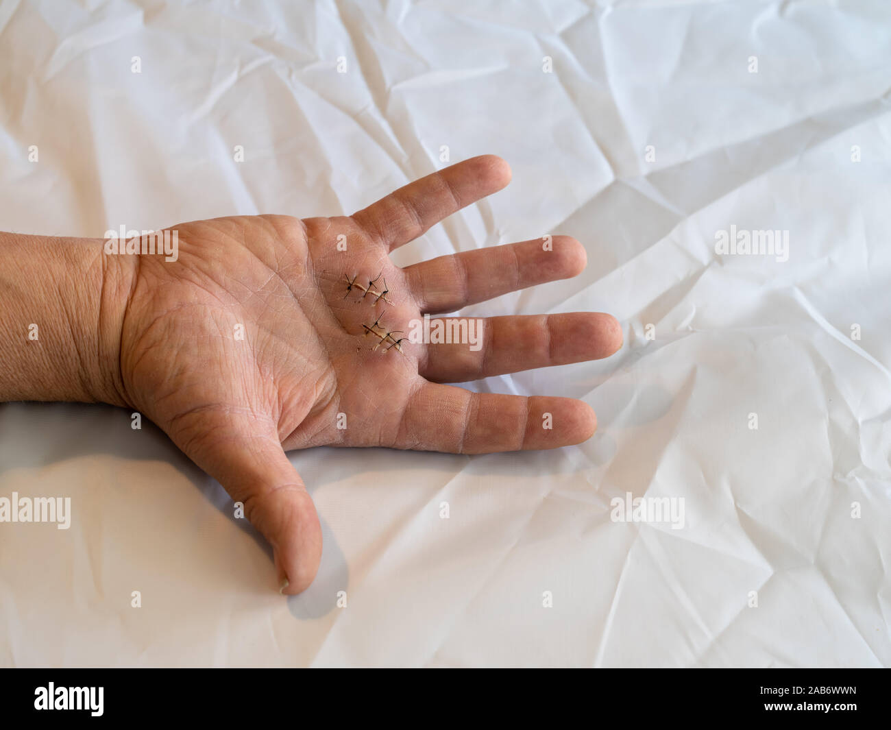 Palm hand wound hi-res stock photography and images - Alamy