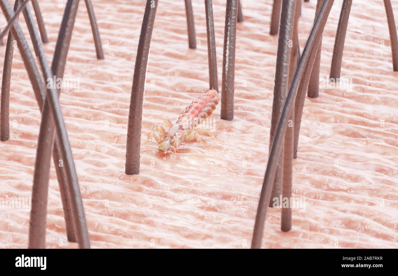 Human head lice infestation hi-res stock photography and images - Alamy