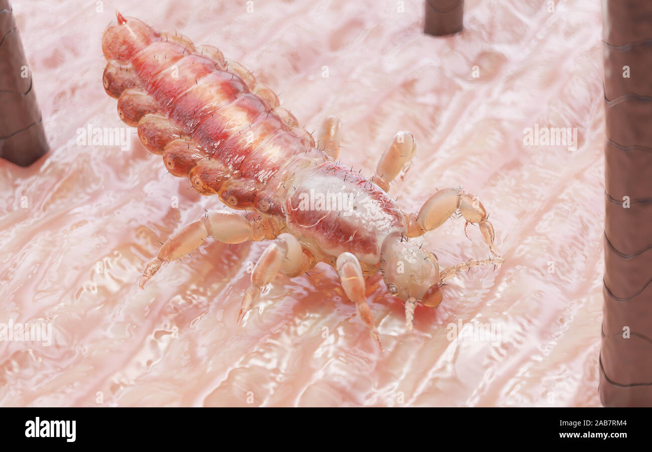 3d rendered illustration of a head louse on a human head Stock Photo ...