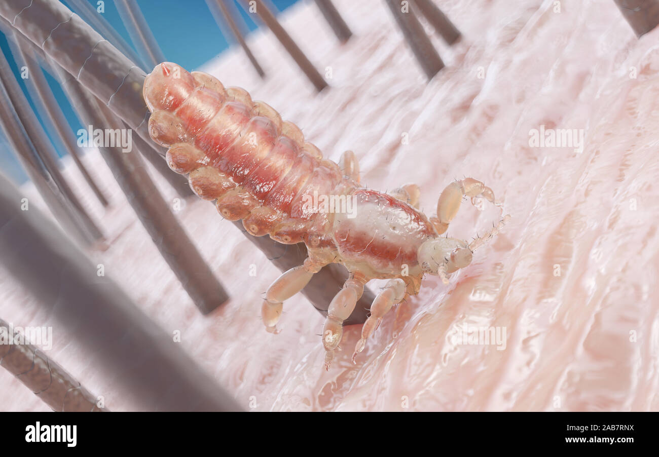 3d rendered illustration of a head louse on a human head Stock Photo ...