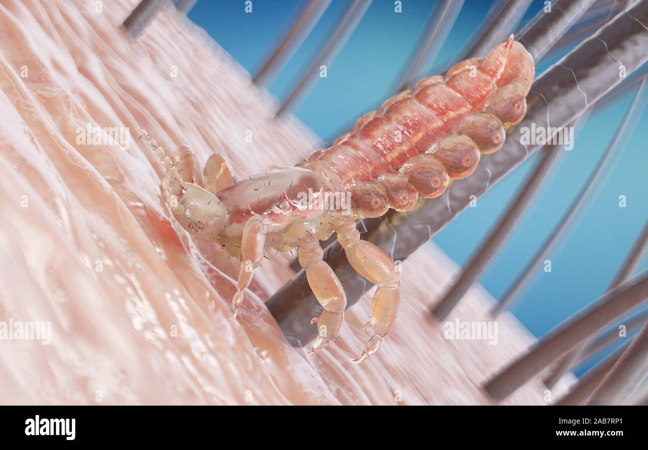 3d rendered illustration of a head louse on a human head Stock Photo ...