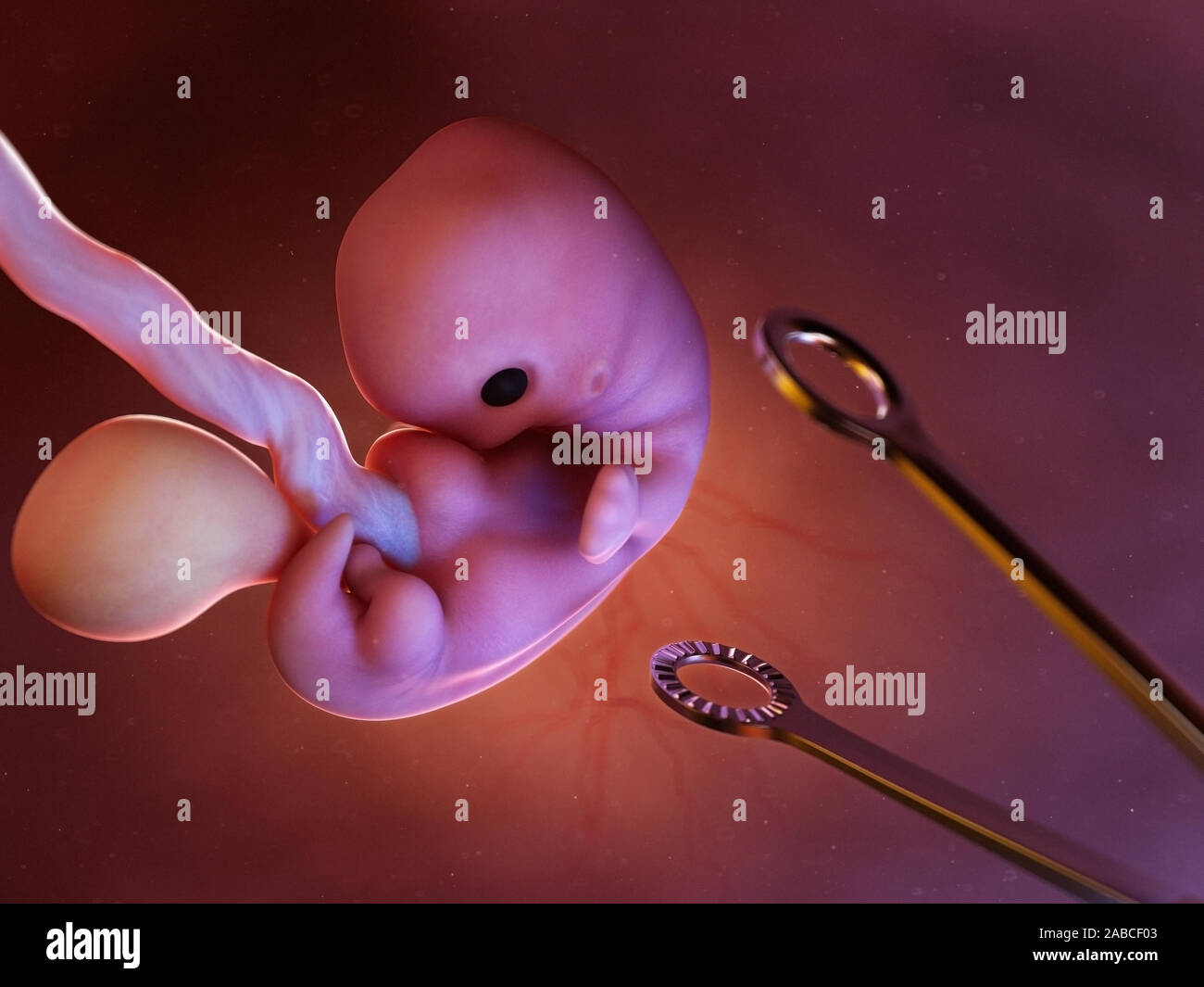 3d rendered medically accurate illustration of a conceptual abortion ...