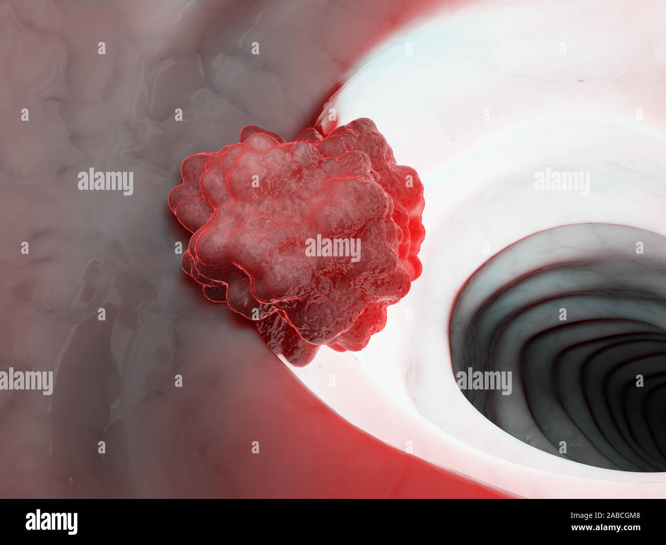 Polyp in the human colon hi-res stock photography and images - Alamy