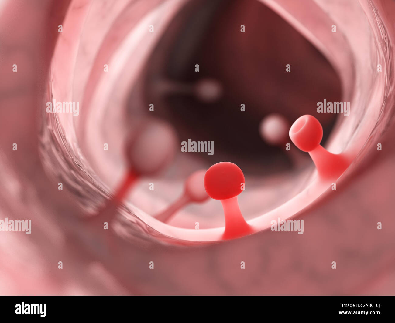 Colon polyps hi-res stock photography and images - Alamy