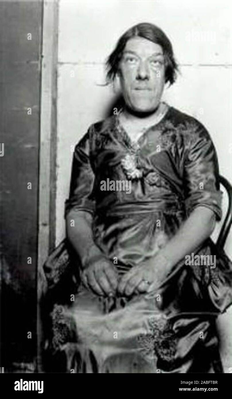 Acromegaly hi-res stock photography and images - Alamy