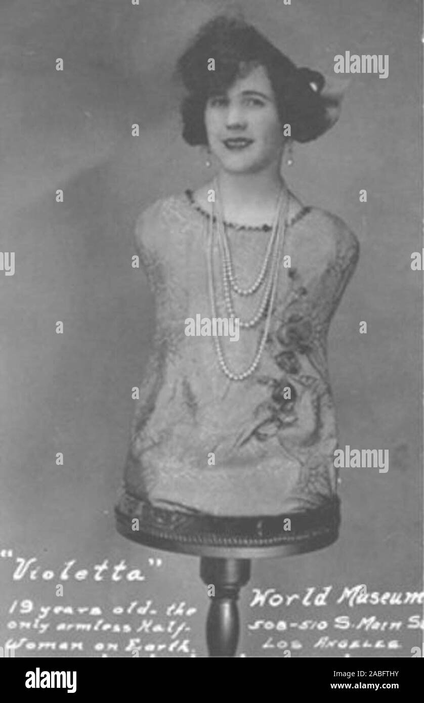 Tetra amelia syndrome hi-res stock photography and images - Alamy