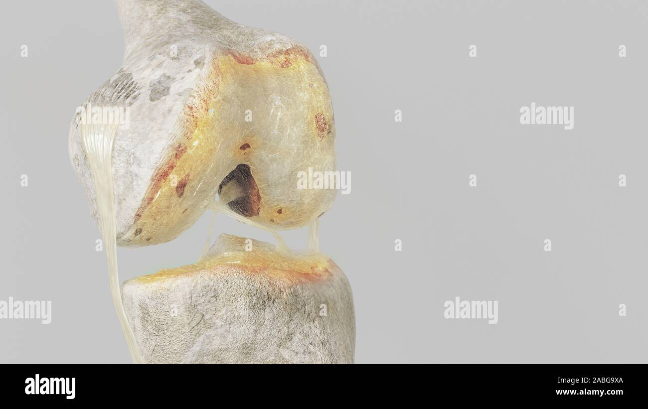 Bone spurring hi-res stock photography and images - Alamy