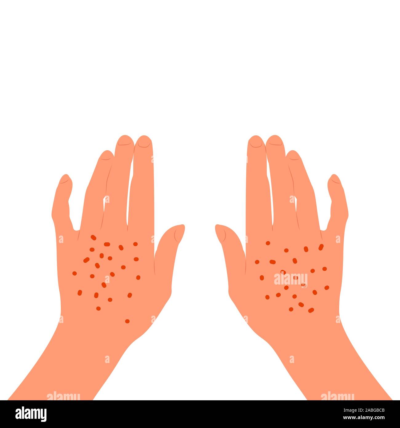 Red rash on the back of the female hands. Skin illness, allergy ...