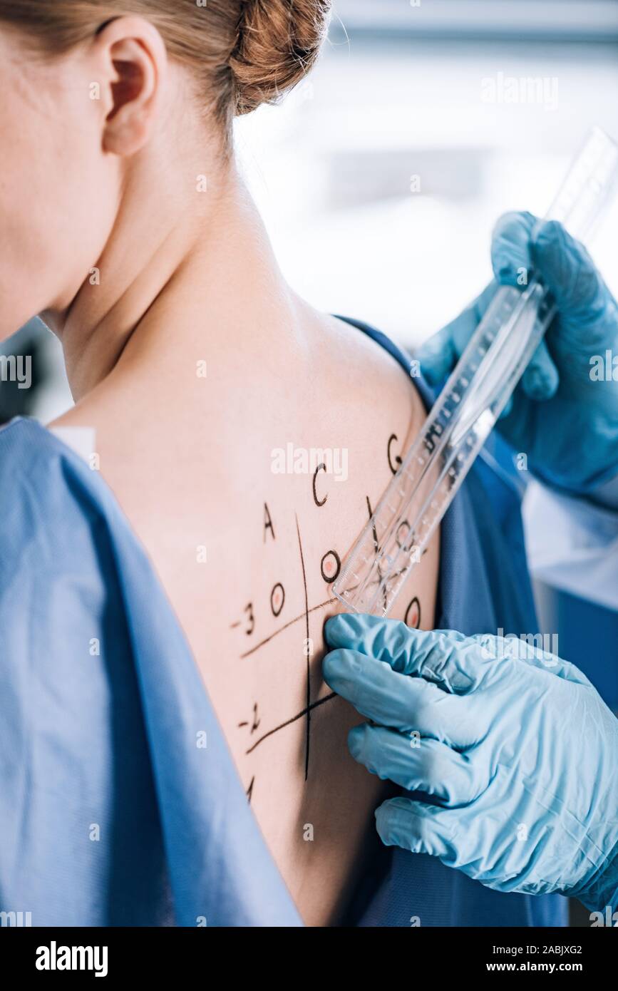 cropped view of allergist in latex gloves holding ruler near patient ...