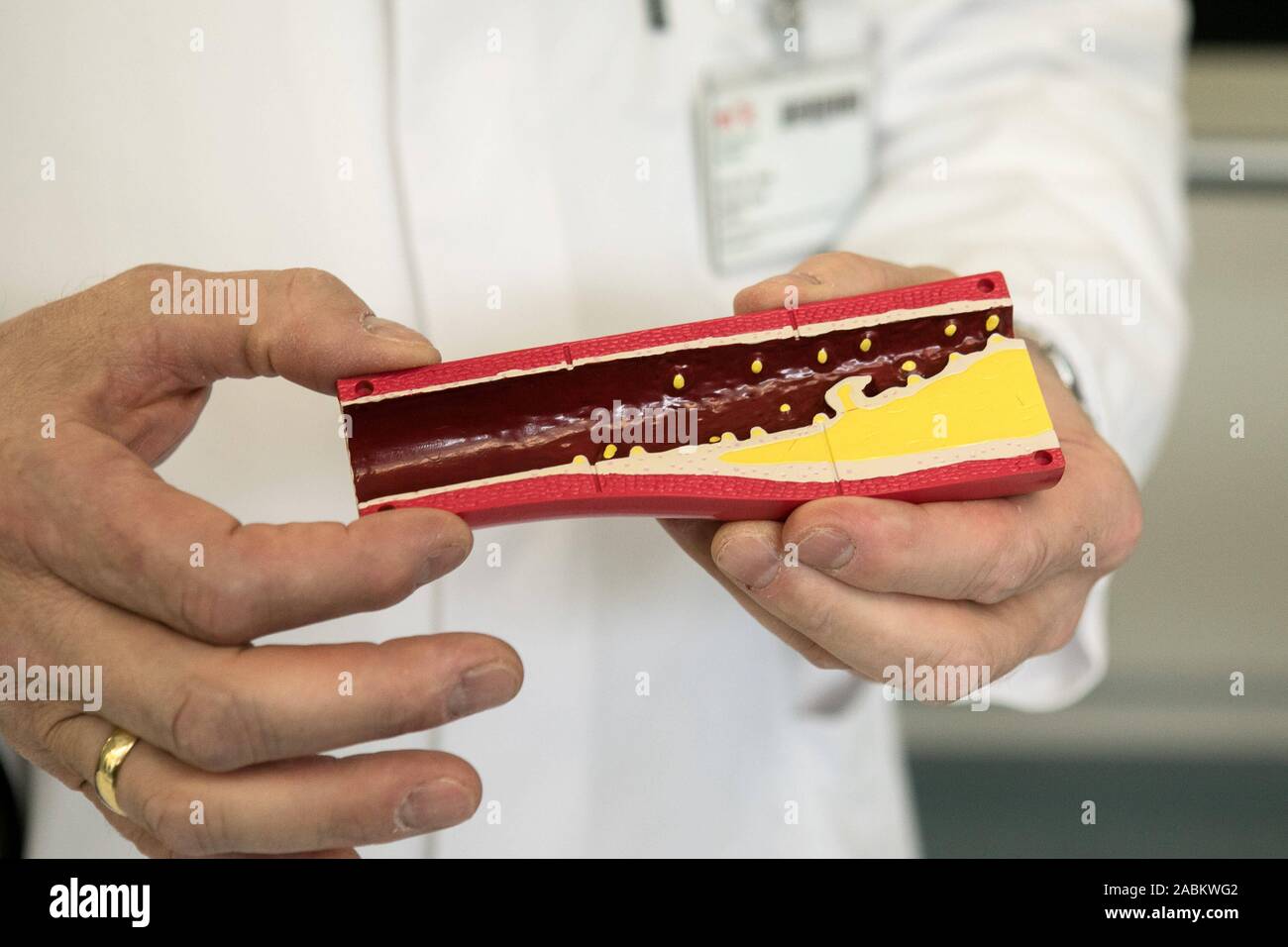 Coronary artery plaque model hi-res stock photography and images - Alamy