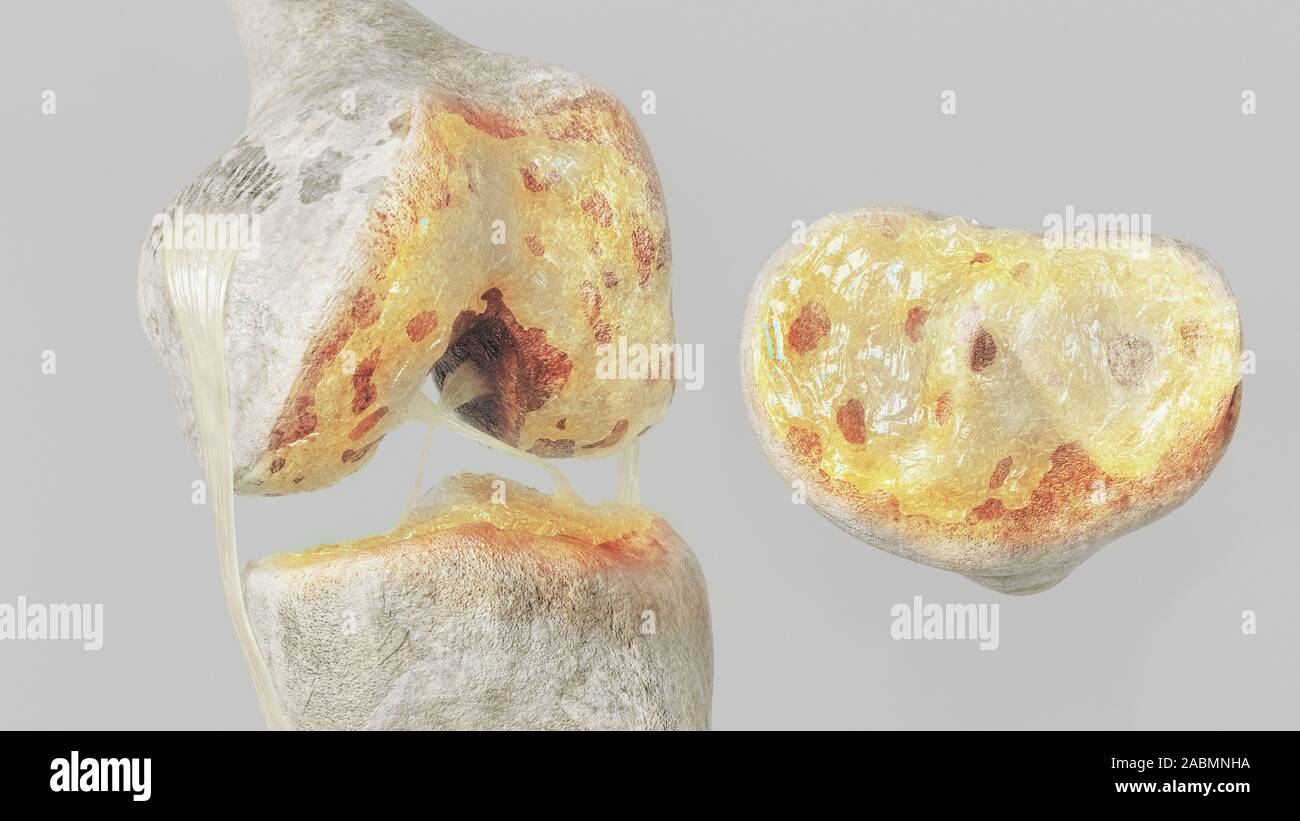 Advanced osteoarthritis - stage 3 - on the knee joint - high degree of ...