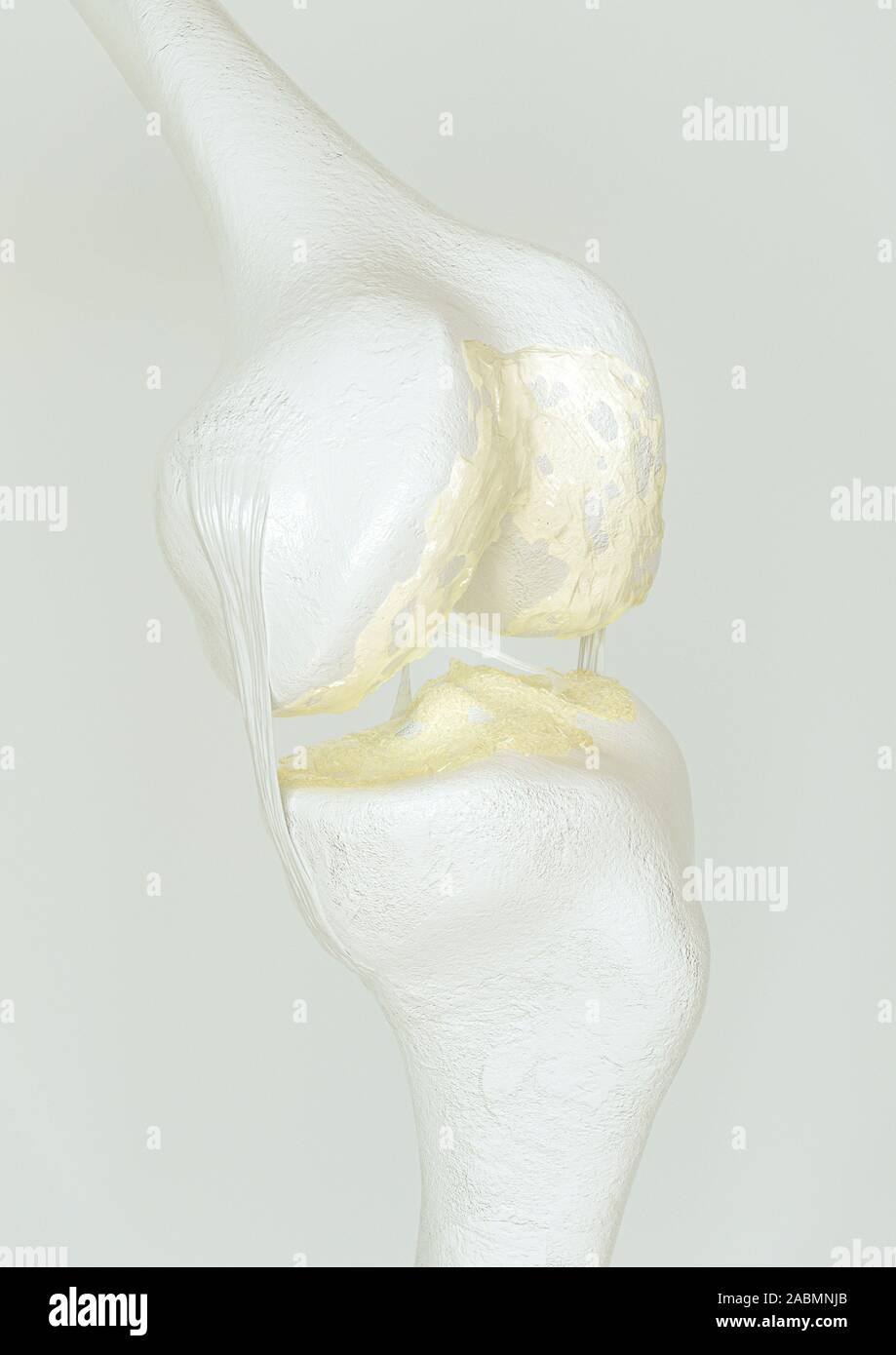 Advanced osteoarthritis - stage 3 - on the knee joint - high degree of ...