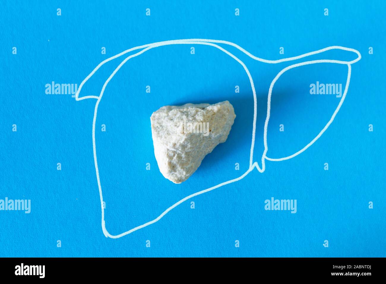 Kidney stone illness concept. Drawing of kidney band real stone Stock ...