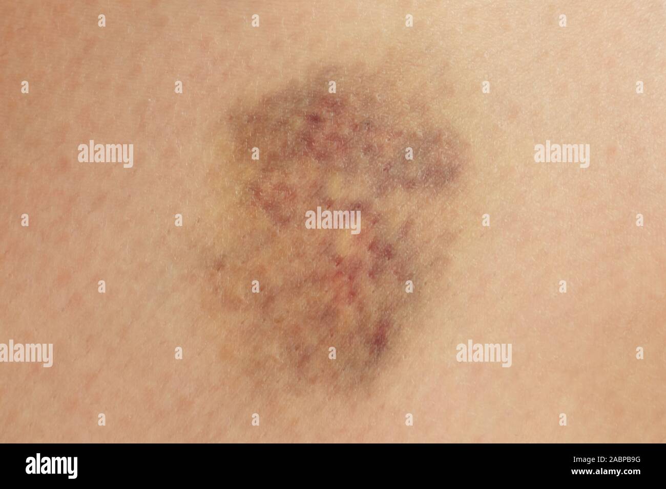 Skin bruise texture hi-res stock photography and images - Alamy